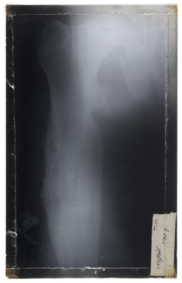Glass x-ray plate taken at Shepherd’s Bush Military Orthopaedic ...