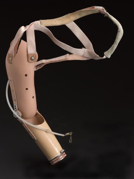 Right arm for an infant with congenital absence of the forearm ...