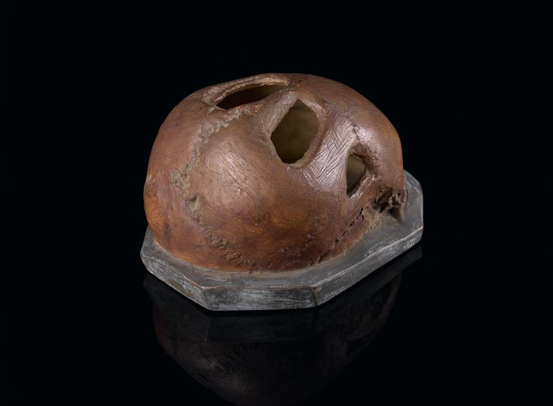Plaster cast of trephined skull | Science Museum Group Collection