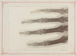 Two x-ray photographs taken c.1896 at Manchester University by Prof ...