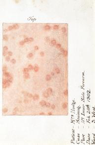 Watercolour illustration of a staining skin disease | Science Museum ...