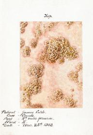 Watercolour illustration of a crust skin disease | Science Museum Group ...