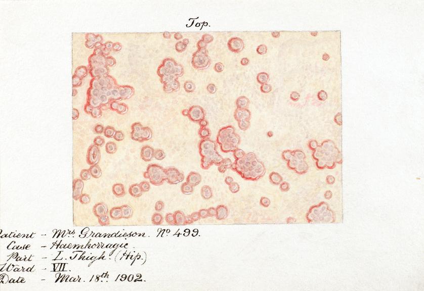 Collection of 15 watercolour illustrations of pox lesions in human skin ...
