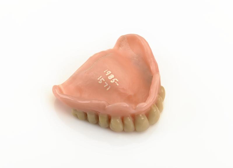 Acrylic upper denture reinforced with orientated polythene woven braid ...