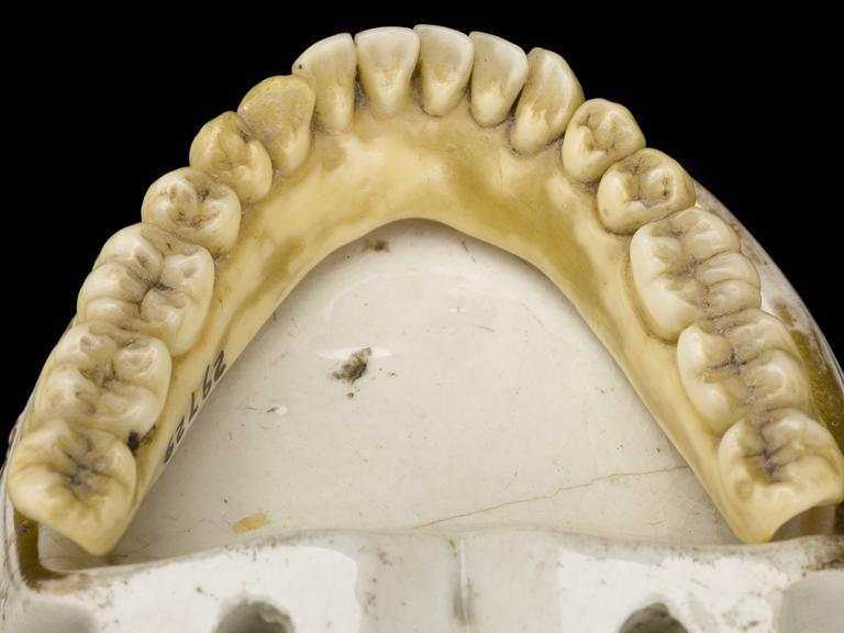 Hippopotamus ivory teeth, lower denture on stand, England, 1795 ...