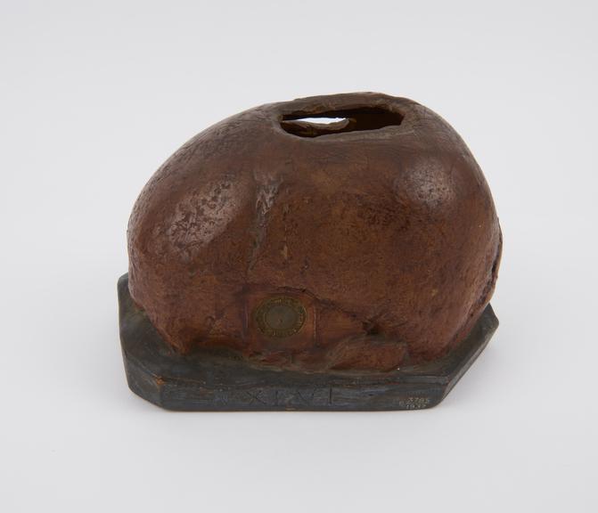Plaster cast of trephined skull | Science Museum Group Collection