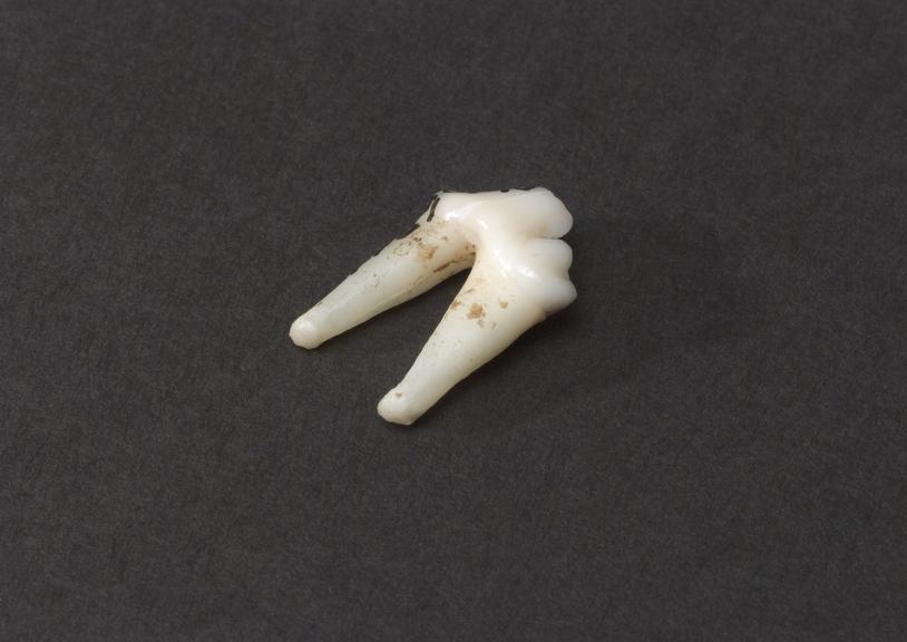 Tooth of female ghoul | Science Museum Group Collection