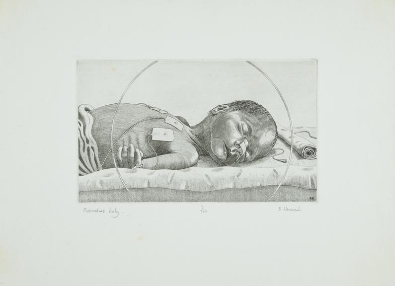 'Premature baby' by Brian Hanscomb, print, 1985 | Science Museum Group ...