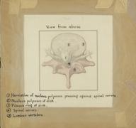 drawing, prolapsed invertebral disc | Science Museum Group Collection
