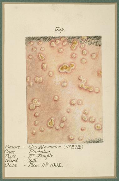 Watercolour illustration of a pustular skin disease | Science Museum ...